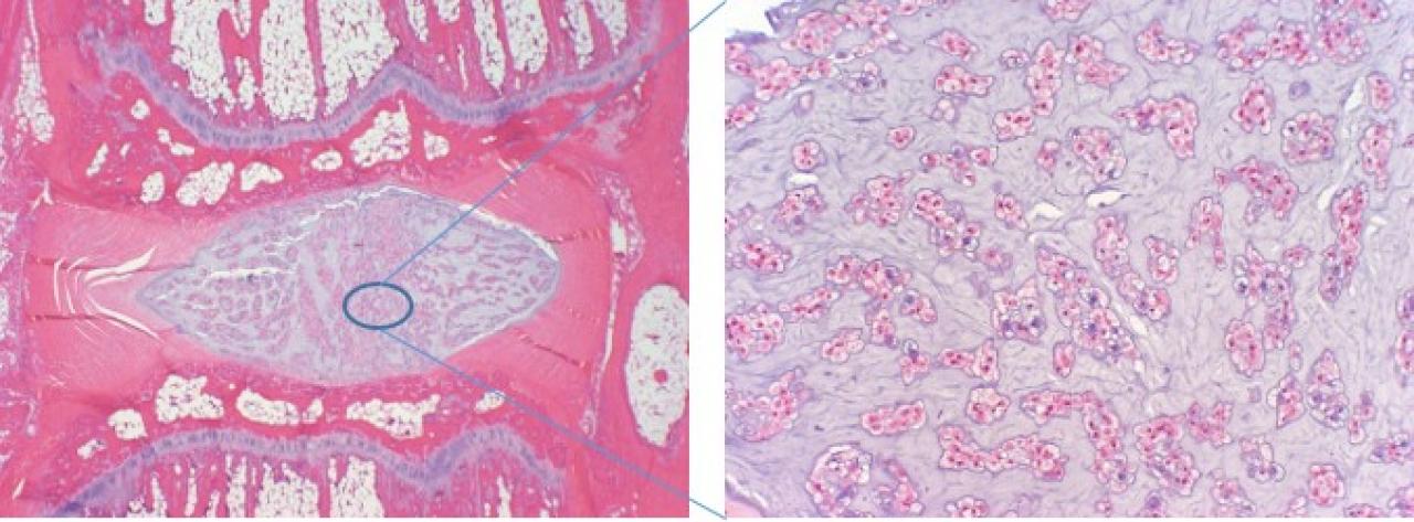 Inflammation and Disc Degeneration | Columbia Orthopedic Surgery