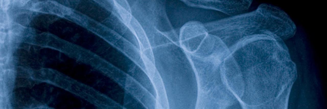 Orthopedic Trauma Treatment - NYC | Columbia Orthopedic Surgery