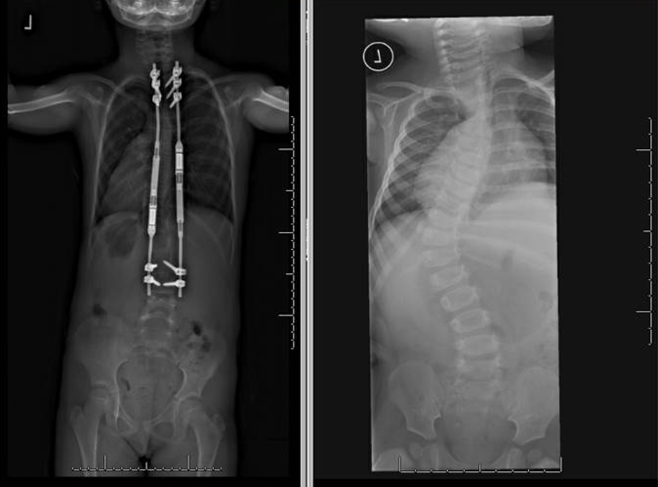 Infantile Idiopathic Scoliosis: Angela's Story | Columbia Orthopedic ...